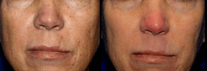 Laser Treatments - Chicago | Dr. Lisa Peters
