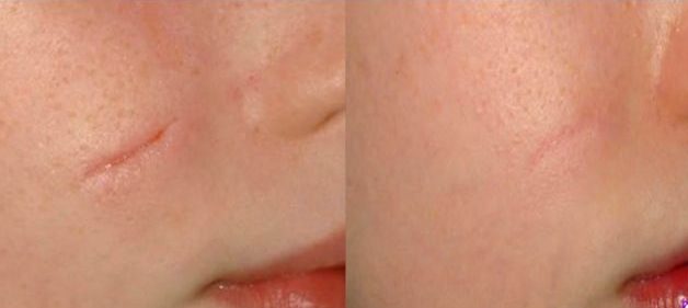 Laser Treatments - Chicago | Dr. Lisa Peters